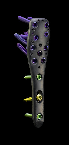 Metal-Free Carbon Fiber Composite Fracture Fixation - Invibio